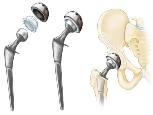 SuperPATH Hip Replacement in Bangalore | Dr Ponnanna KM