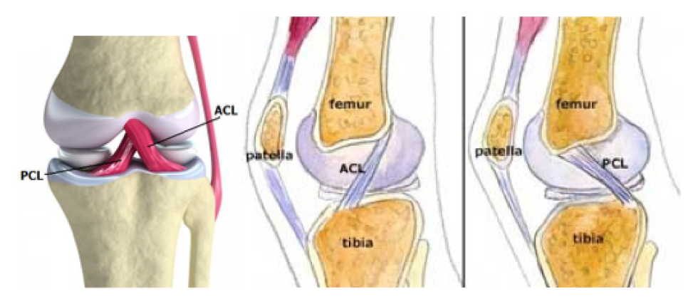 Arthroscopic PCL Reconstruction in Bangalore | Dr Ponnanna KM